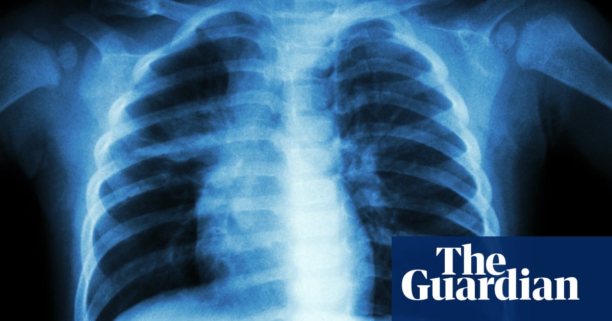 Kansas officials say tuberculosis outbreak is largest on record in US ...