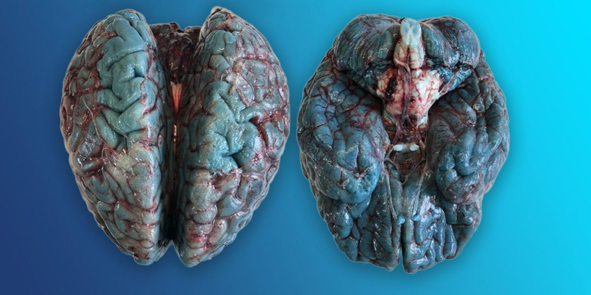 Autopsies showed unusual blue-colored brains — scientists have now ...