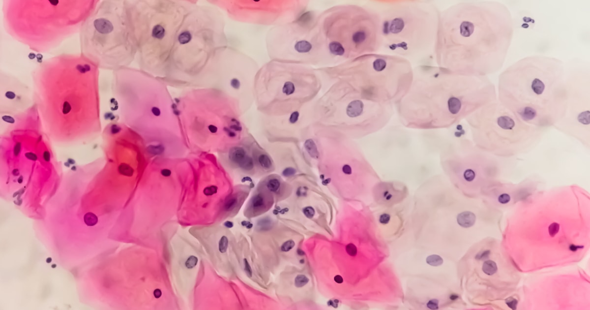 Cancer organization suggests at-home HPV test for cervical cancer ...